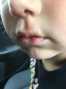 Pictures of eczema on adults: Types of dermatitis with rash images