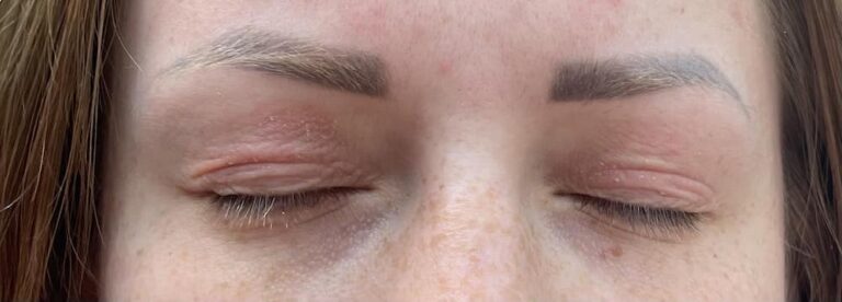 Pictures of eczema on adults: Types of dermatitis with rash images