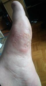 Pictures of eczema on adults: Types of dermatitis with rash images