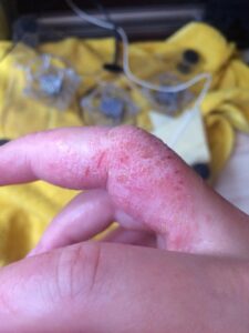 Pictures of eczema on adults: Types of dermatitis with rash images