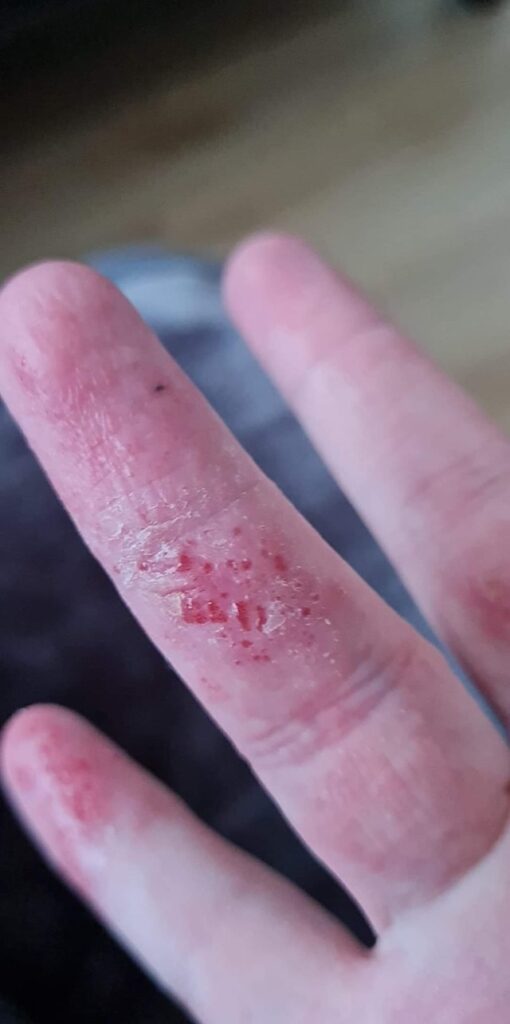 Pictures of eczema on adults: Types of dermatitis with rash images