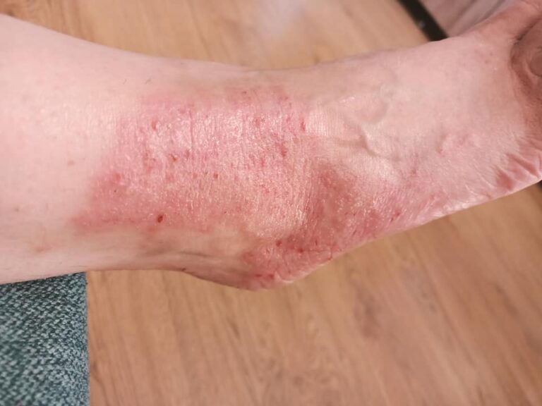 Pictures of eczema on adults: Types of dermatitis with rash images