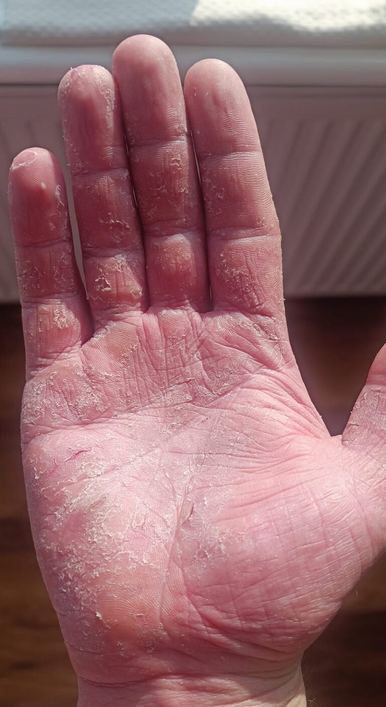 Pictures of eczema on adults: Types of dermatitis with rash images
