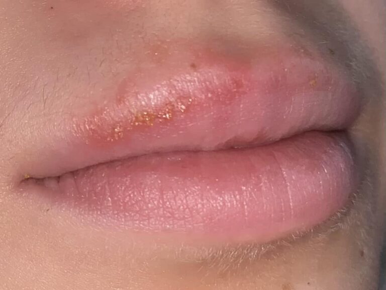 Pictures of eczema on adults: Types of dermatitis with rash images